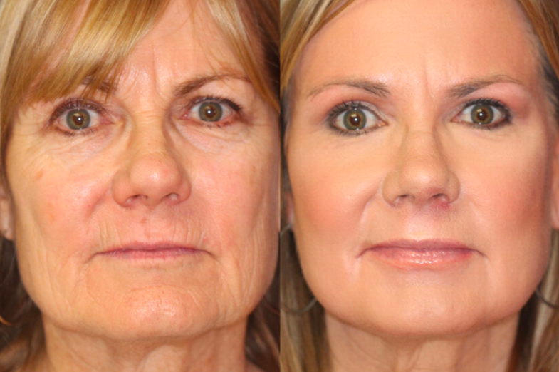 Care este cel mai bun tratament antirid, anti-imbatranire?