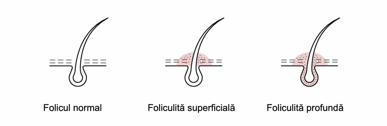 Ce este foliculita și cum se tratează? - Doctor SKiN