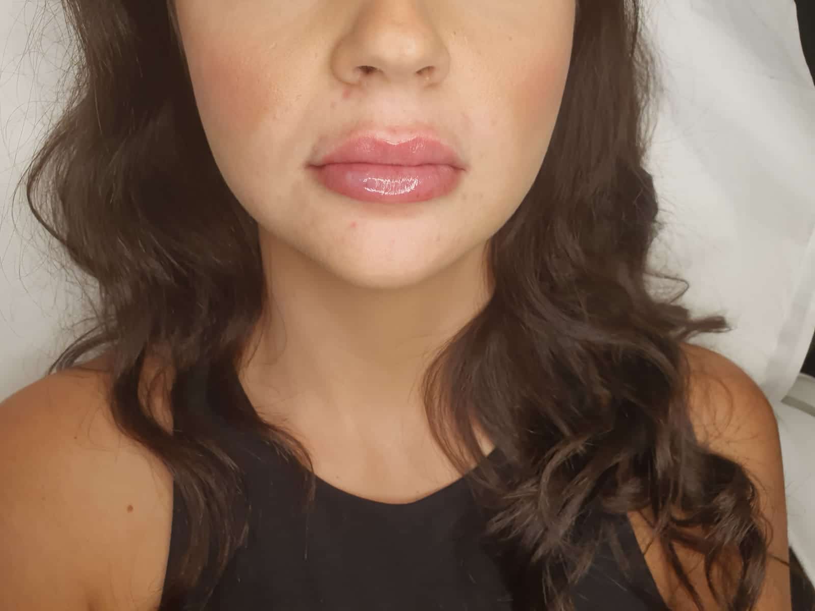 Tot ce trebuie să știi despre Acidul Hialuronic - Doctor SKin