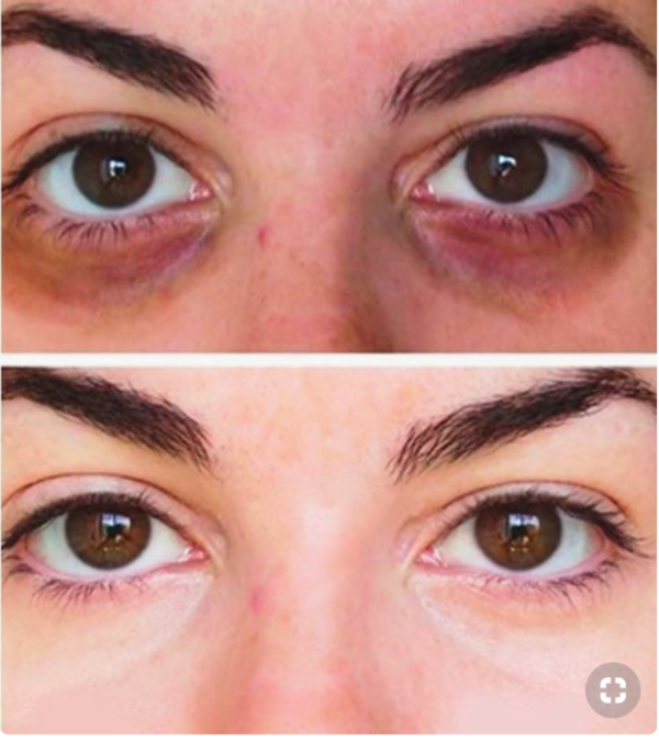 Cel mai bun tratament pentru cearcăne | Doctor SKiN București