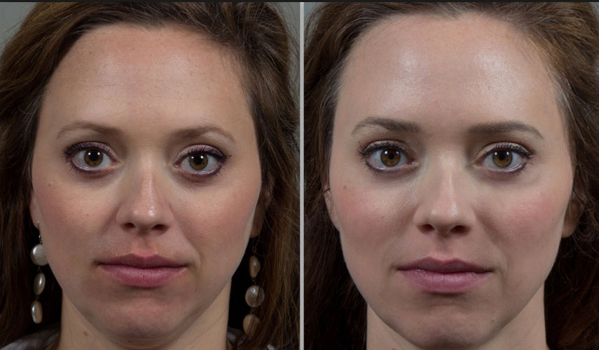 Care este cel mai bun tratament antirid, anti-imbatranire?