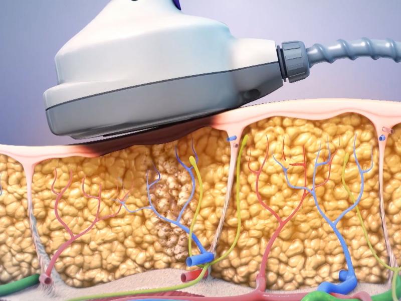 UltraShape V3 cel mai eficient tratament medical de eliminare a ...