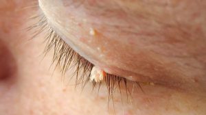 Tratament pentru Negi și Veruci: De ce apar, care sunt pericolele și ...